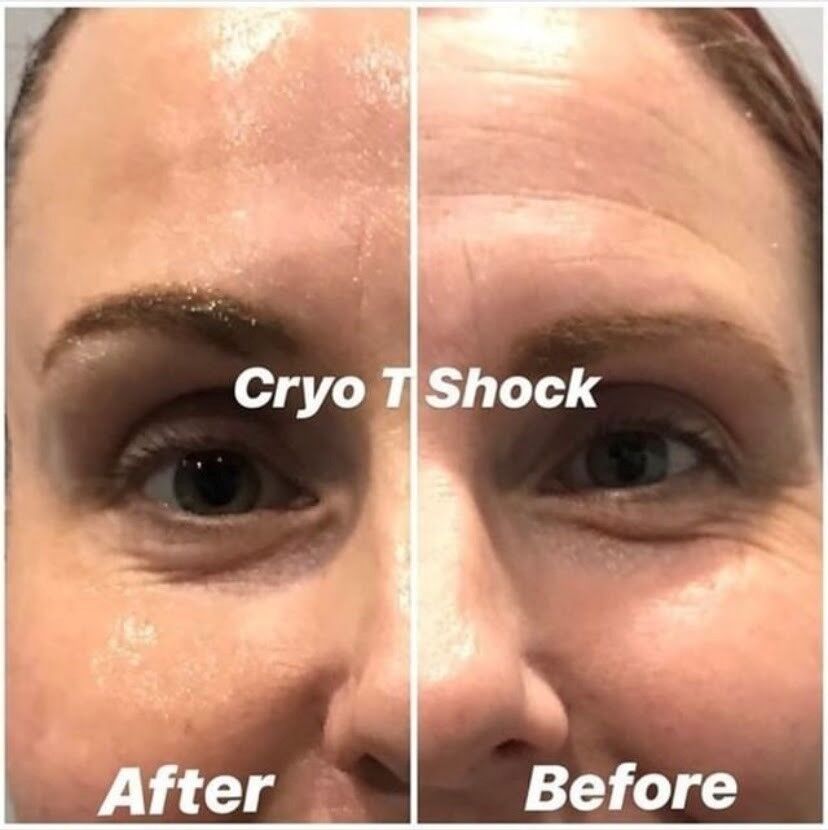 Recovery Science Inc Cryo Facials Are The Best Recovery Science Inc